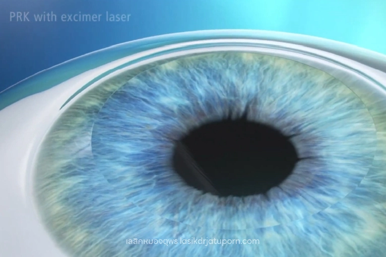 เปรียบเทียบความแตกต่าง Trans PRK - LasikDrJatuporn