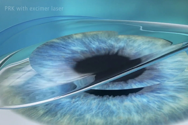 เปรียบเทียบความแตกต่าง Trans PRK - LasikDrJatuporn